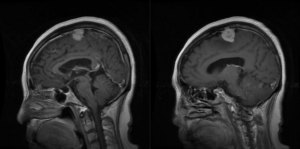Brain Tumor Classification with NVIDIA TAO Toolkit - HVALABS