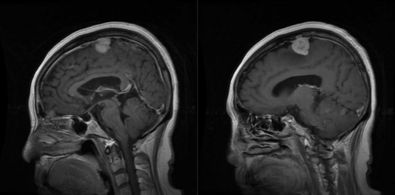 Brain Tumor Classification with NVIDIA TAO Toolkit - HVALABS
